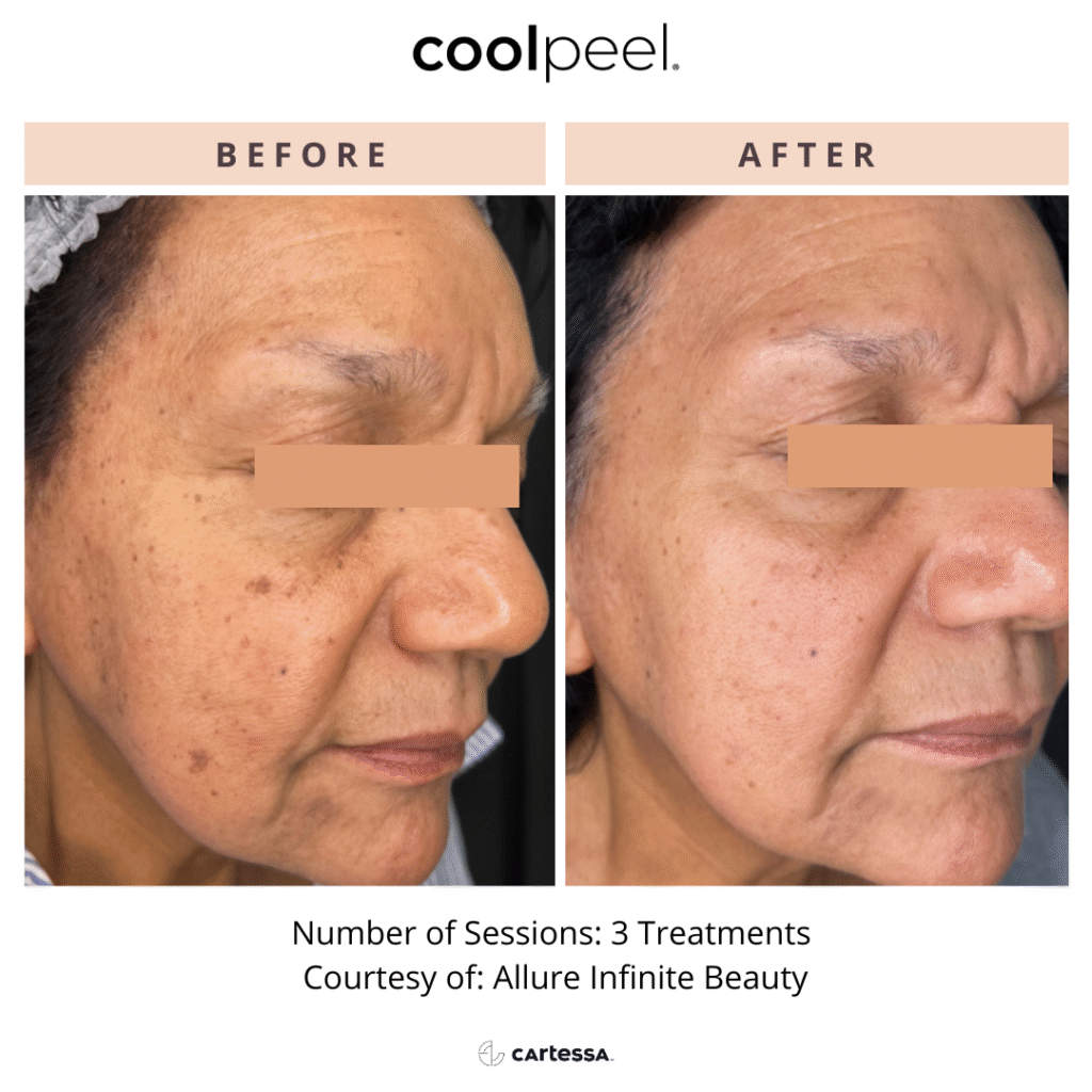Helix CO2 Laser Treatments - The Skin Center at Southgate Medical Group
