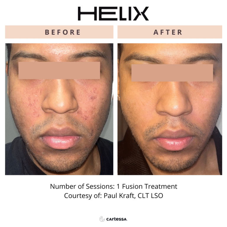 Helix CO2 Laser Treatments - The Skin Center at Southgate Medical Group